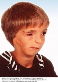 Anomalías en el desarrollo embrionario. :: Procesos genéticos y ...